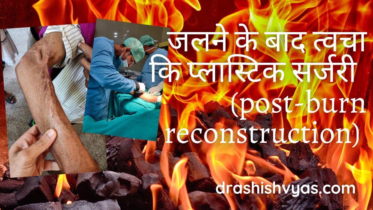 Post Burn Reconstruction (जली हुई त्वचा के लिए प्लास्टिक सर्जरी ...