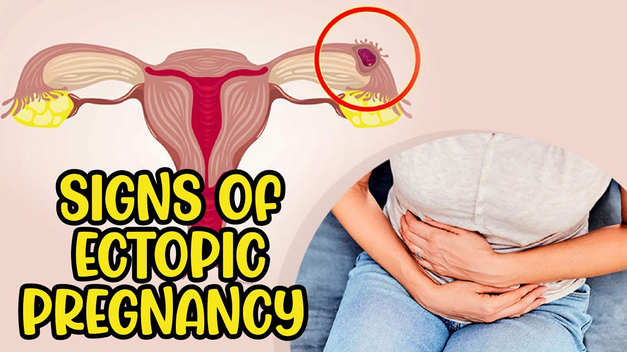 Signs of Ectopic Pregnancy – Causes and Symptoms - YouTube