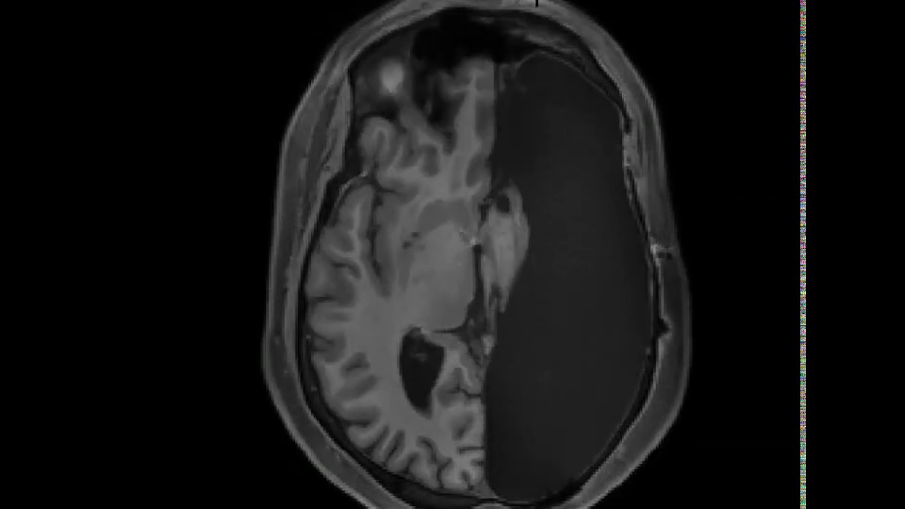 MRI Brain Scan With One Hemisphere Removed - YouTube