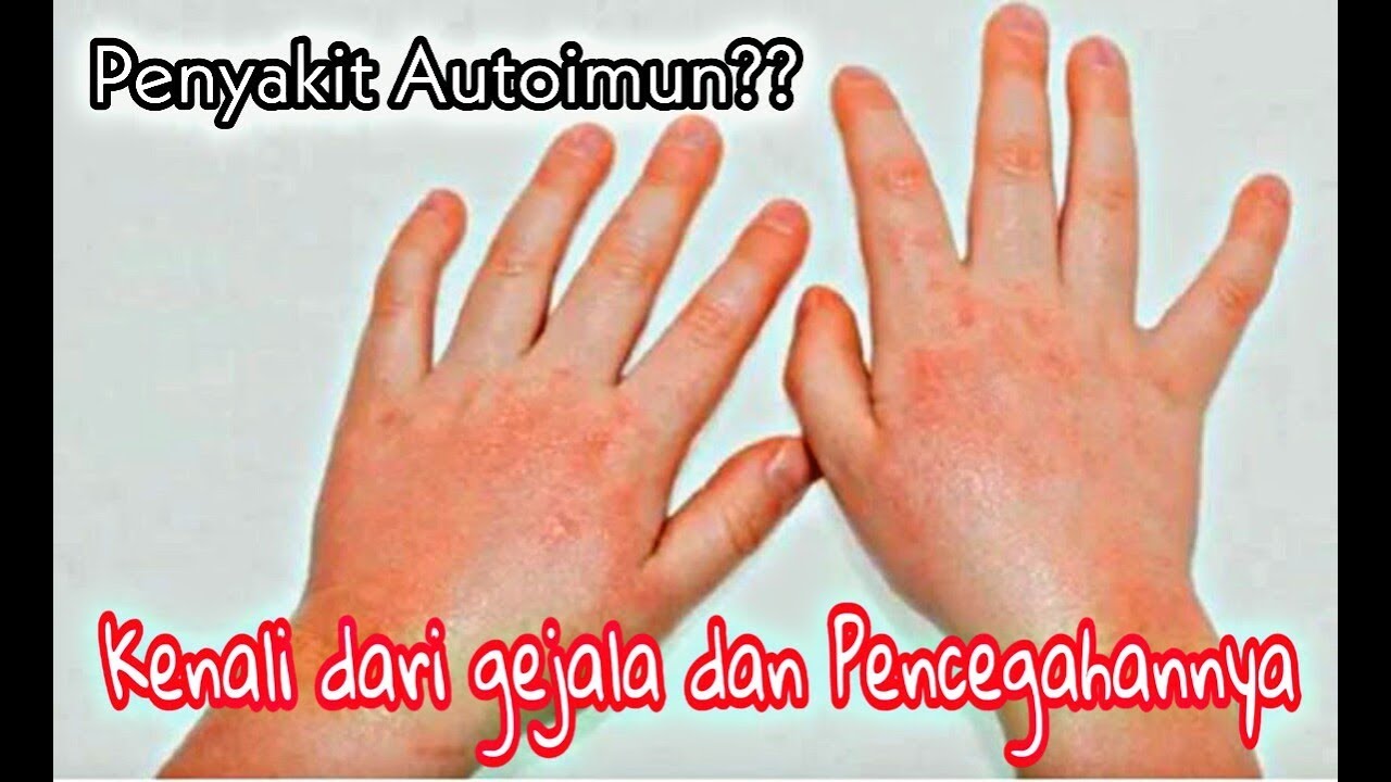 Mengenali penyakit Autoimun mulai dari gejala hingga Pencegahan - YouTube