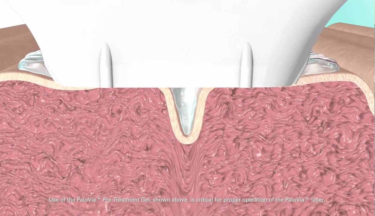 How the PaloVia Skin Renewing Laser Works - YouTube