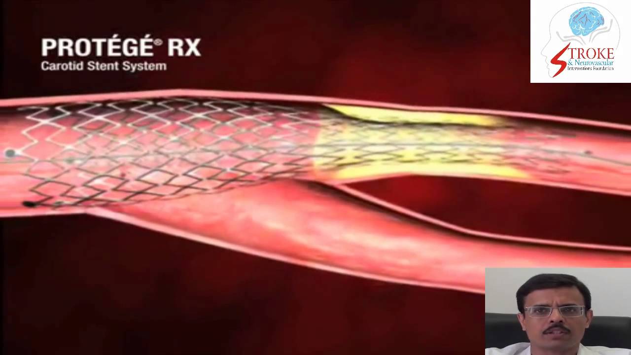 Carotid Stenting Technique - YouTube