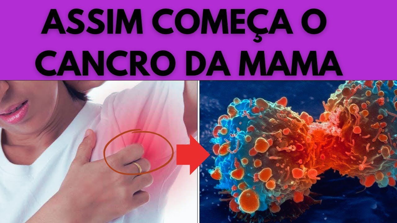 É Assim que Começa o Cancro da Mama e NINGUÉM TOMA CUIDADO – SINAIS e ...
