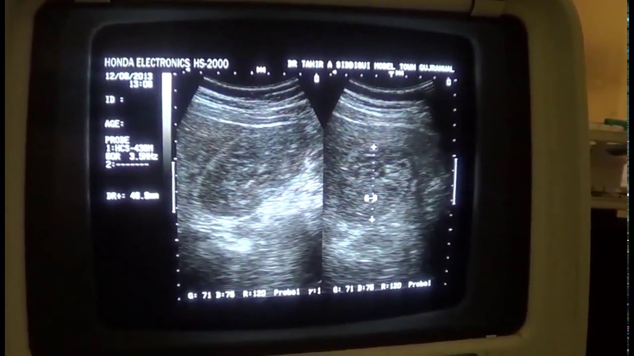 MUCOCELE vs AGGRESSIVE GALL BLADDER pathology - YouTube