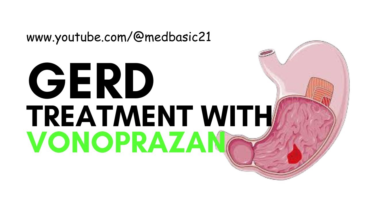 GERD treatment with Vonoprazan | stomach gas problem solution | GERD ...