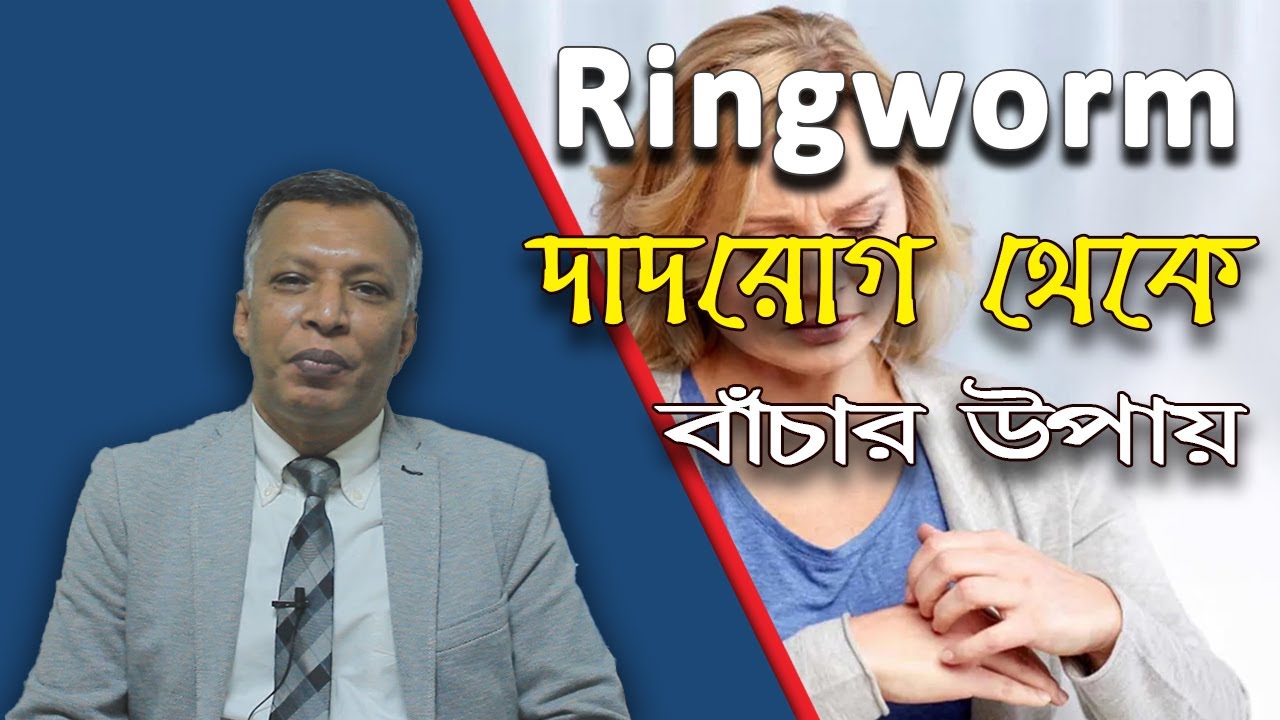দাদ রোগ থেকে বাঁচার উপায় ।। ডা. এম আর করিম রেজা।। Ringworm - YouTube