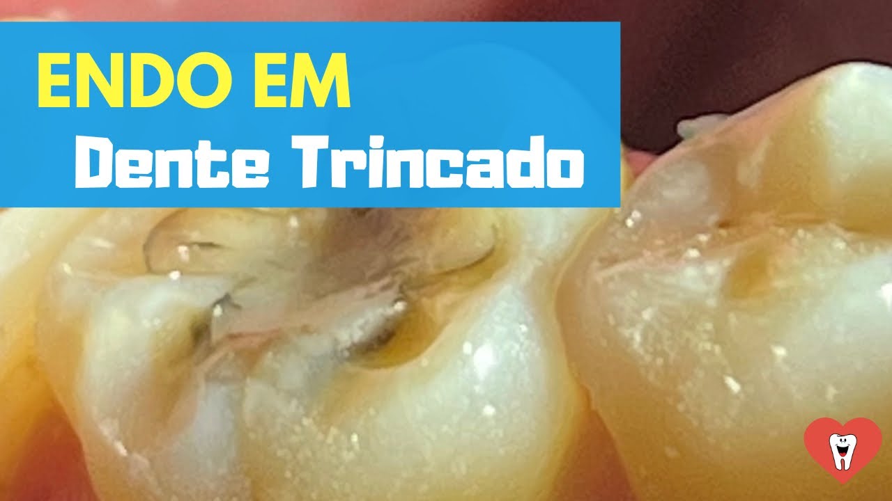 SAIBA ISSO ANTES DE SAIR FAZENDO ENDO EM DENTE TRINCADO! - Endolovers ...