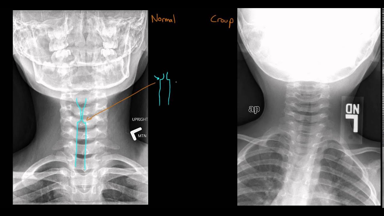 Croup Dx and Tx - YouTube
