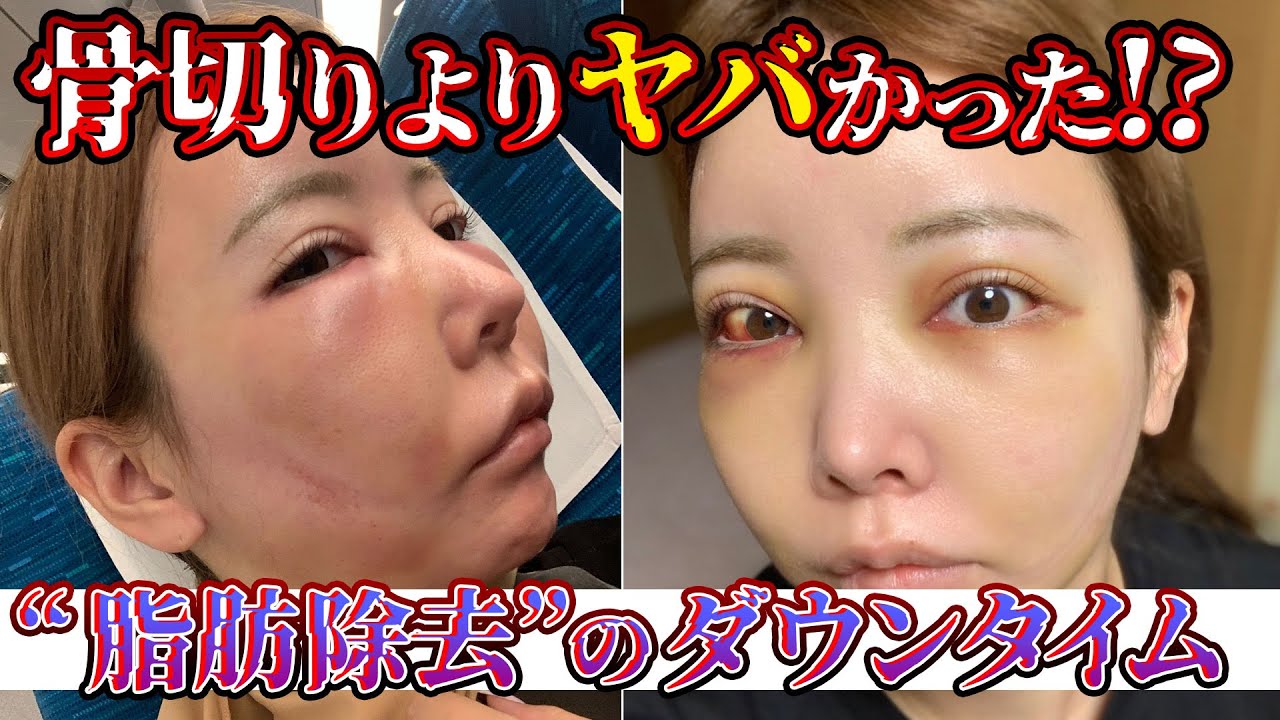 【整形】過去最大級にヤバすぎたダウンタイム。ジョール・メーラーファット除去の実態 Youtube