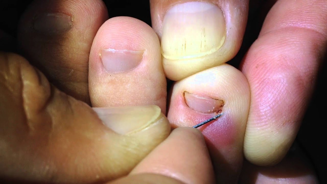 Método para retirar bicho de pé sem danificar a capsula da Pulga ...