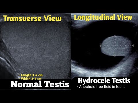 Testis Ultrasound Normal vs Abnormal Appearances Comparison Ultrasound ...
