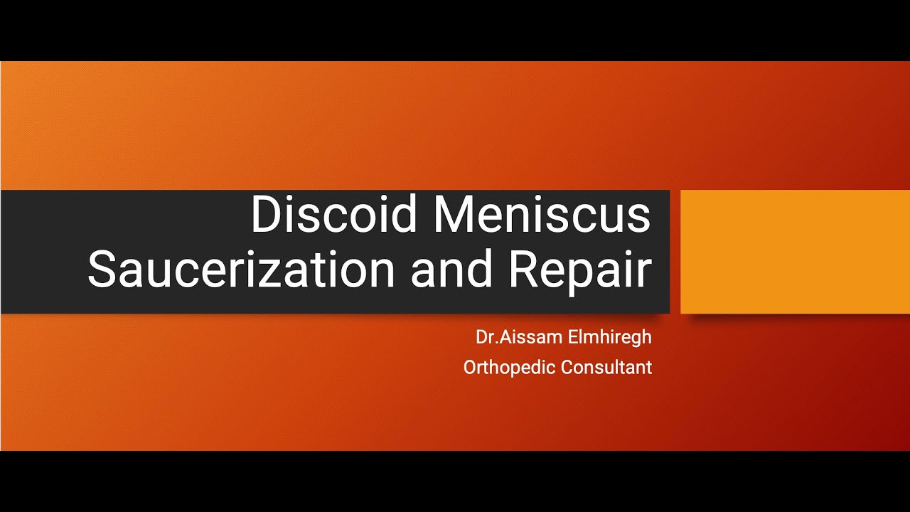 Discoid Meniscus Saucerization and Repair - YouTube