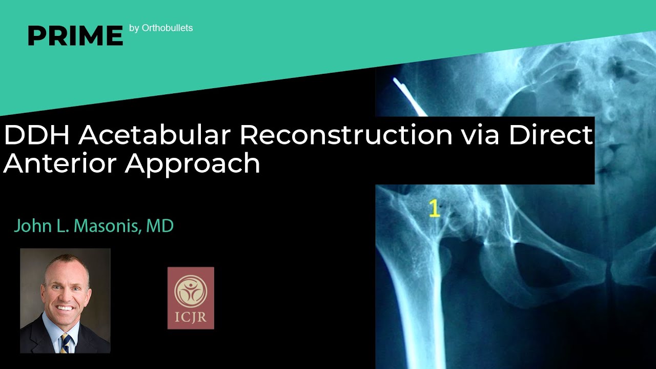 DDH Acetabular Reconstruction via Direct Anterior Approach - John L ...