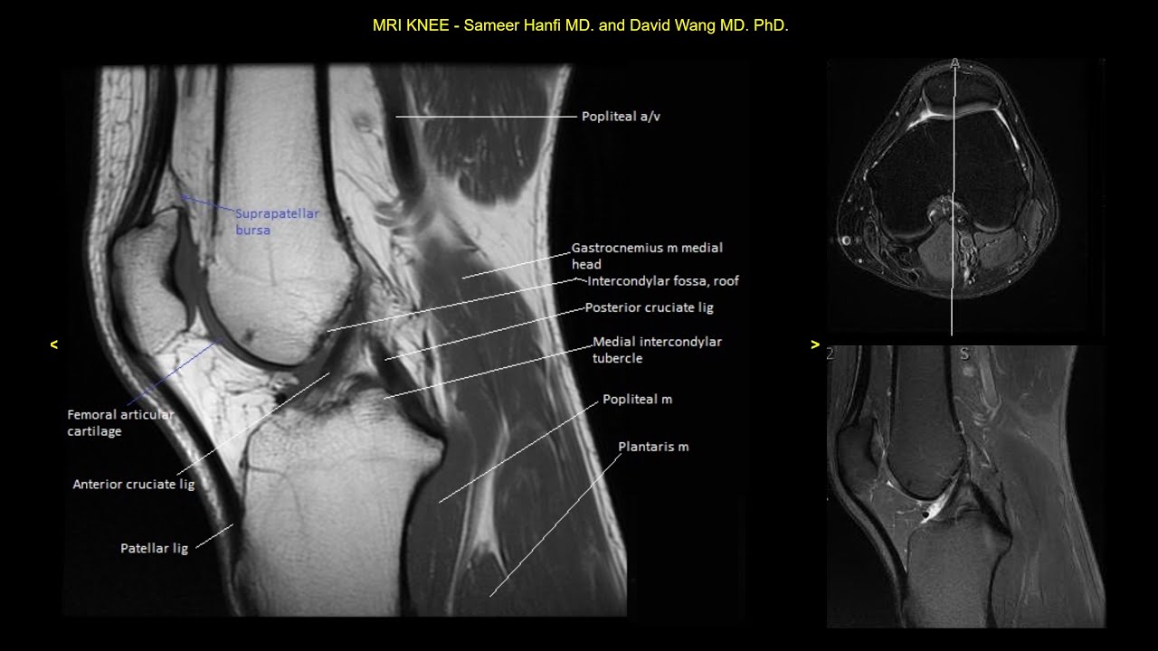Knee MRI Anatomy Atlas - YouTube