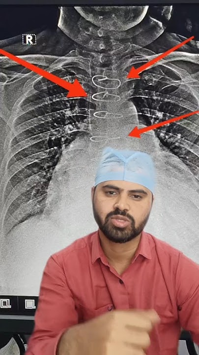 Chest Xray - YouTube