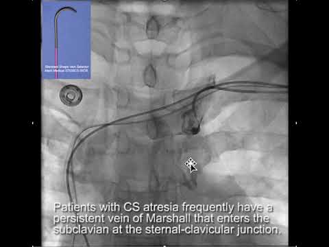 LV lead implant via a patent vein of Marshall by Dr Santangeli with ...