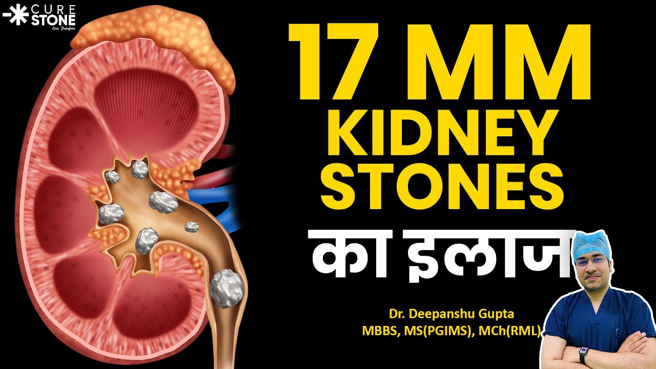 17mm Kidney Stone का इलाज | बड़े किडनी स्टोन का इलाज | Kidney Stone ...