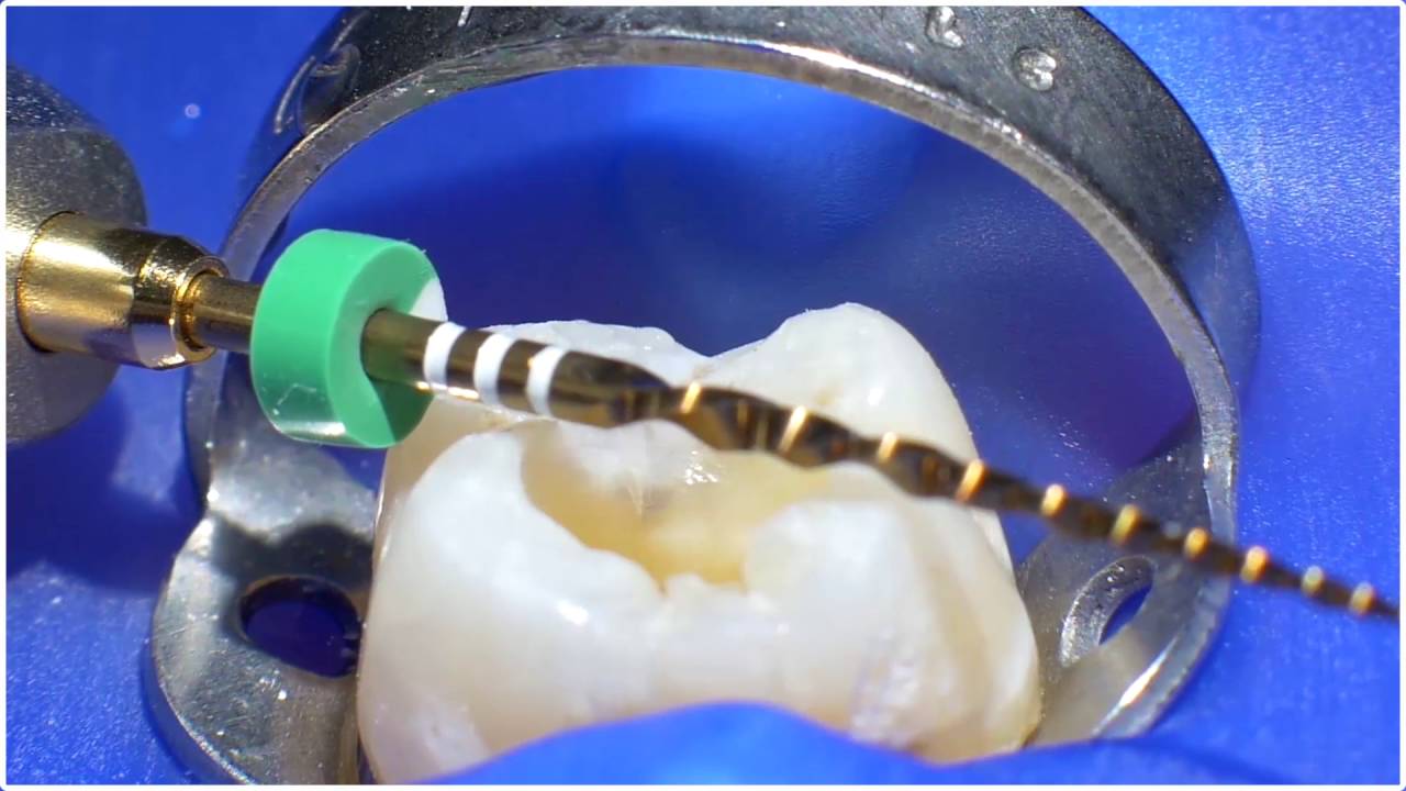 WaveOne Gold ® Technique - Dr. Willy Pertot | Dentsply Sirona - YouTube