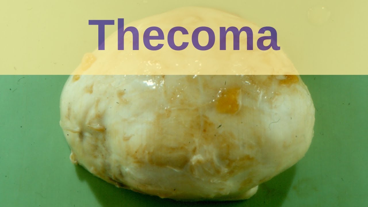 Ovarian Thecoma - Pathology mini tutorial - YouTube