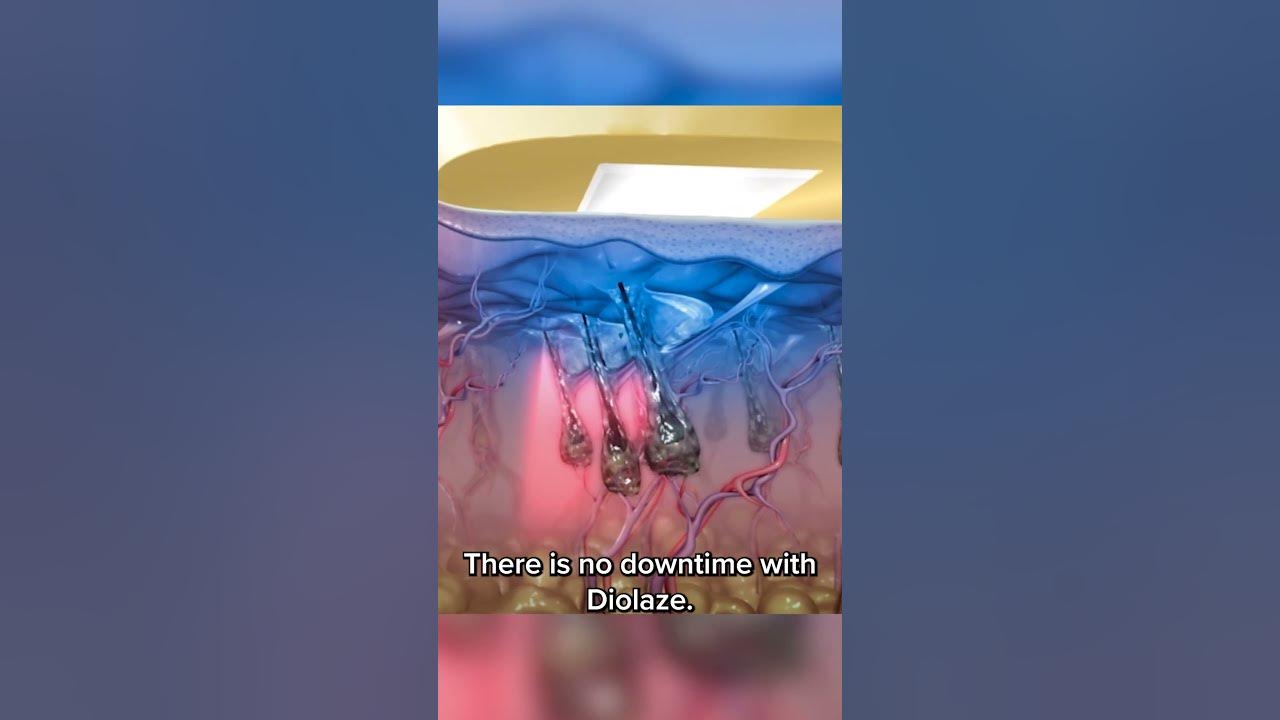 Diolaze Laser Hair Removal at North Atlanta ENT & Allergy - YouTube