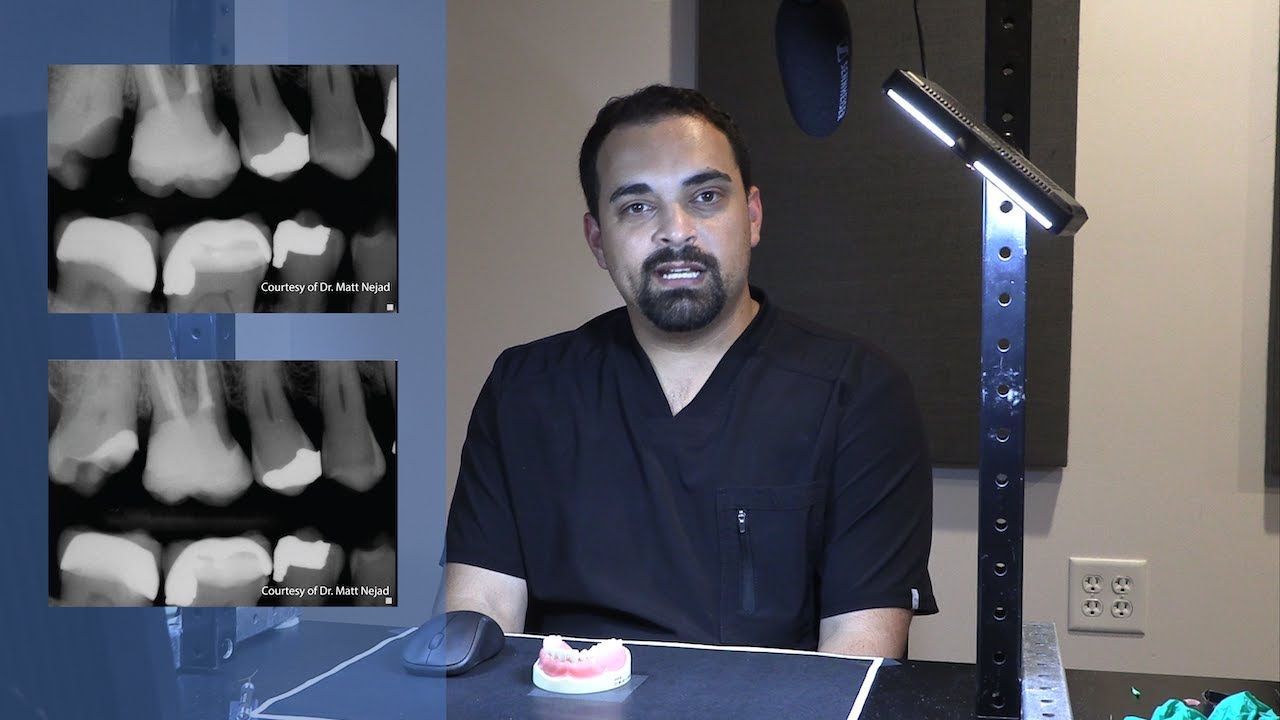 What is Deep Margin Elevation and Why Should Dentists Care? | Dr. JD ...
