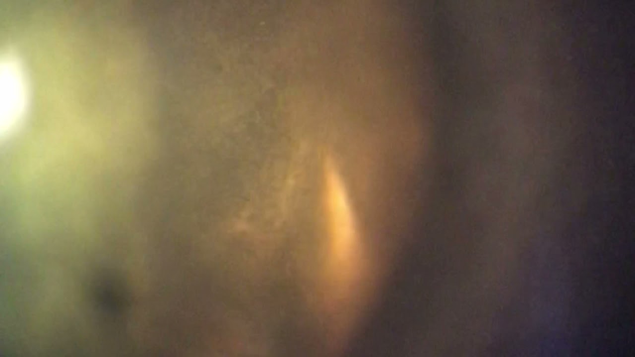 Vitreous haemorrhage || Anterior Vitreous Examination || Slit lamp ...