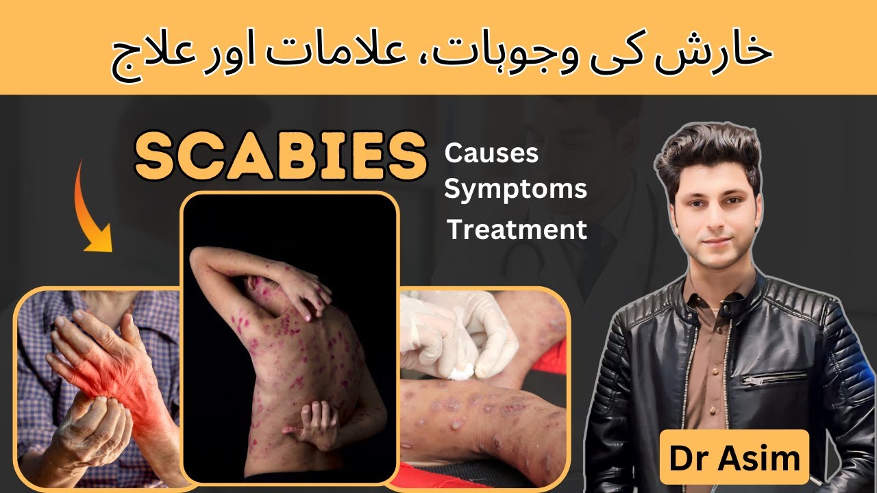 Scabies Causes, Symptoms and Treatment explained in simple words / by ...