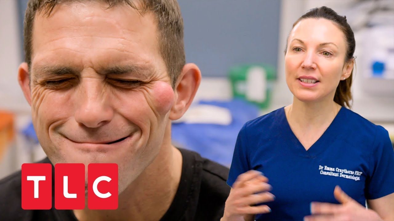 Eine Riesenzyste und gerötete Haut | Dr. Emma - Hautärztin aus ...