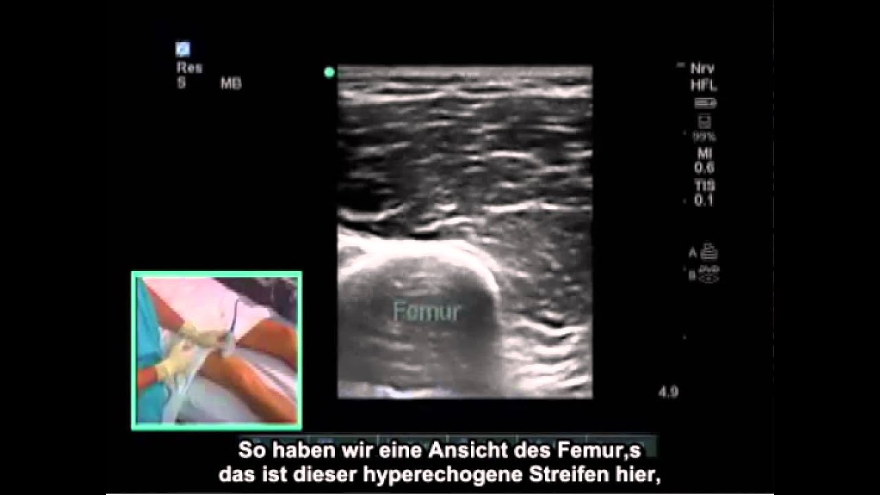 Anleitung: Ultraschallgeführte Blockade des Nervus saphenus - YouTube