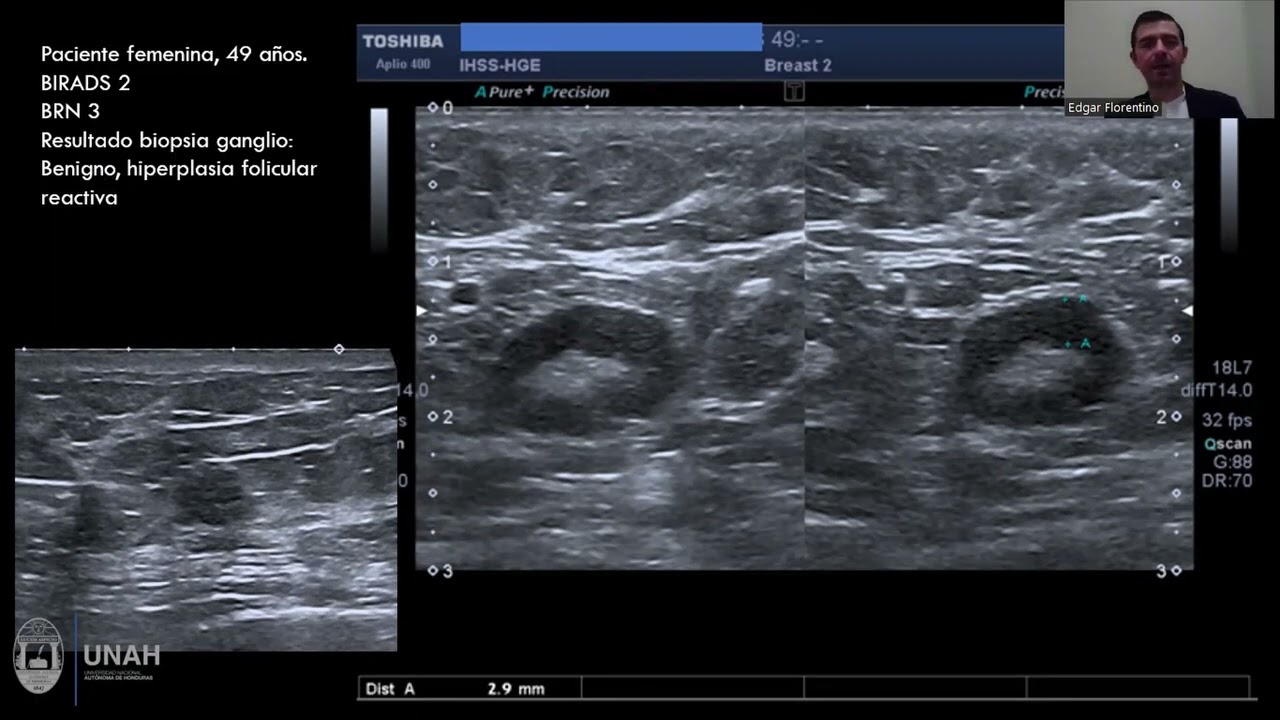 Utilidad del ultrasonido para detectar Metástasis Linfática Axilares ...