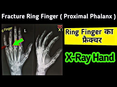 Fracture Ring Finger || Fracture Proximal Phalanx || X-Ray Hand ...