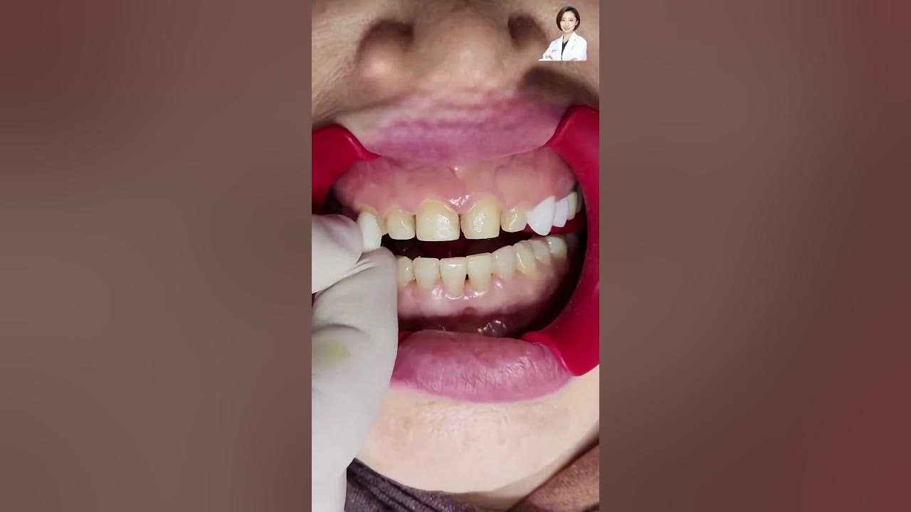 Different from Closing brackets Teeth... - YouTube