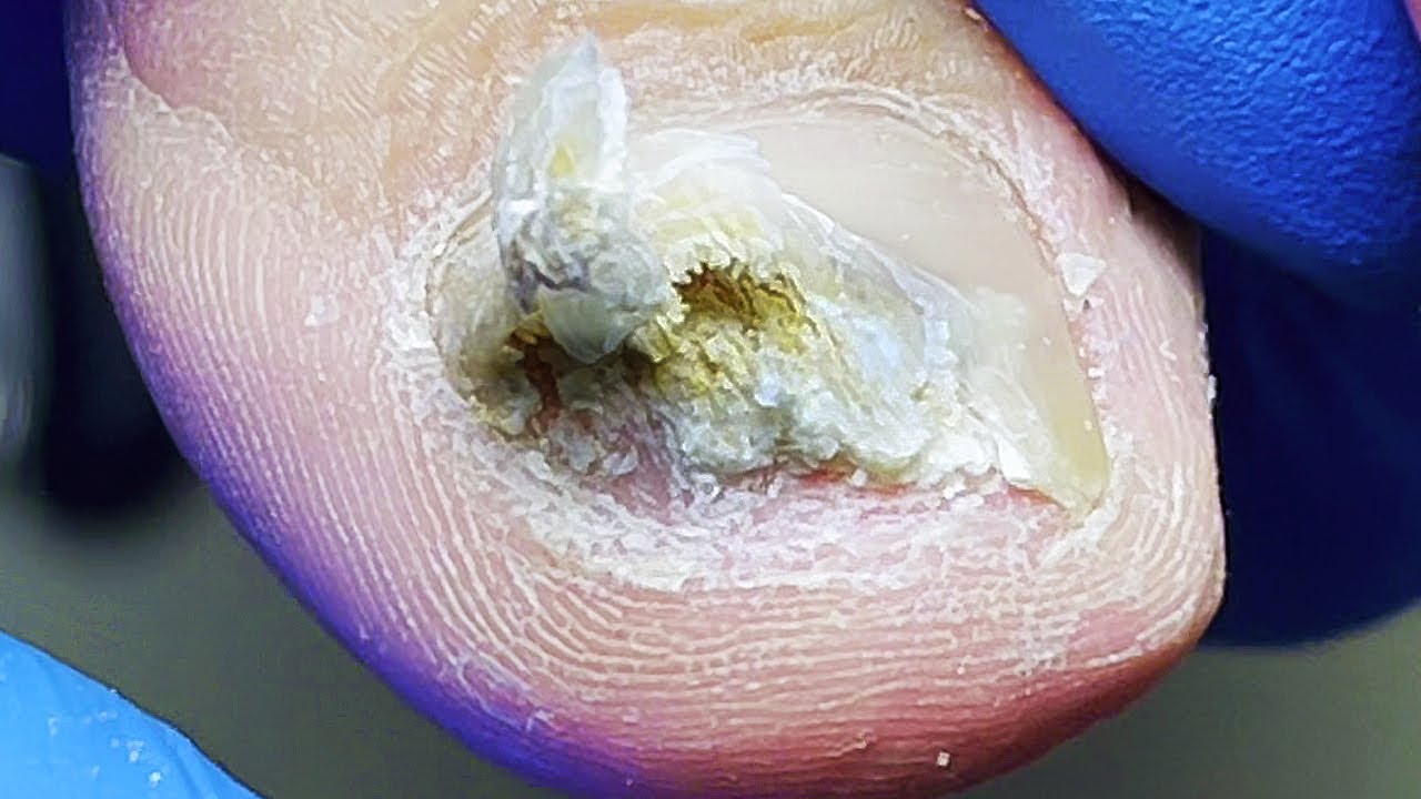 Rock-like toenails,hard and thick,remove them layer by layer with ...