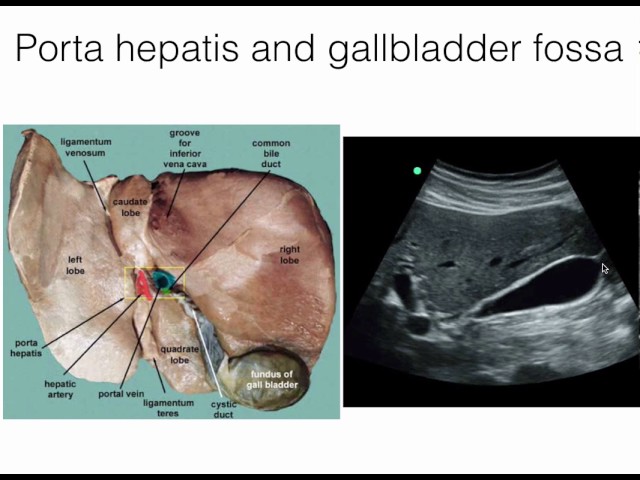 Cystic Gall Bladder Fossa