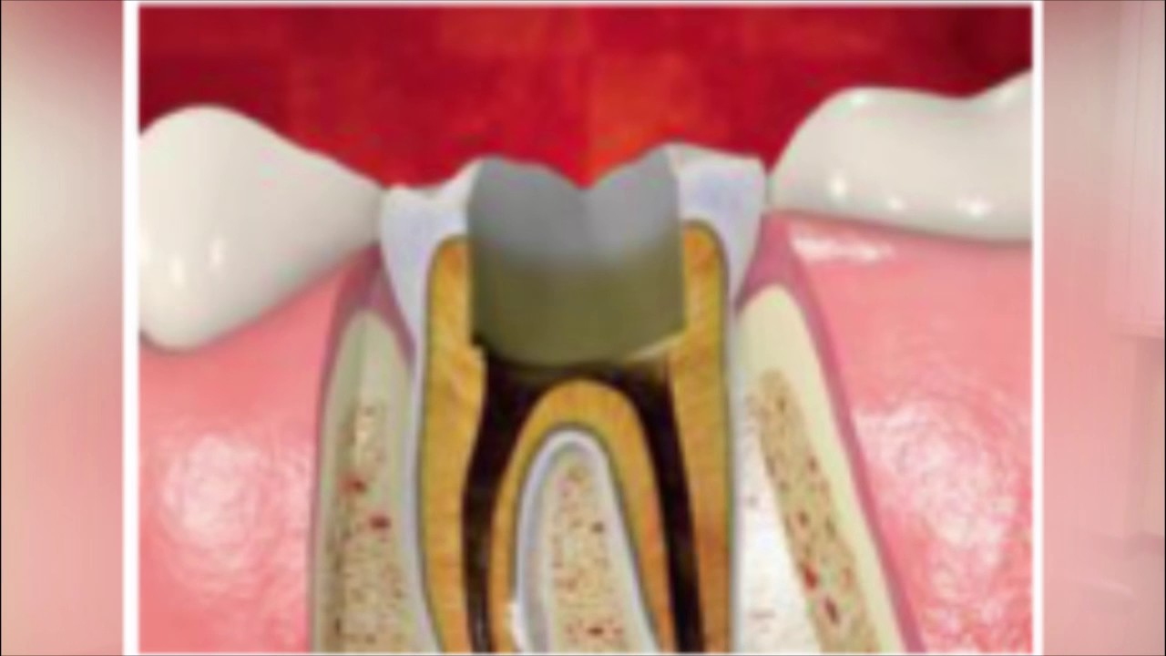 SoftPrep - гель для обробки кореневих каналів - YouTube