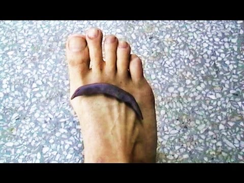 Pijawki Lekarskie Lecznicze - Skuteczne Leczenie Pijawkami - Medycyna ...