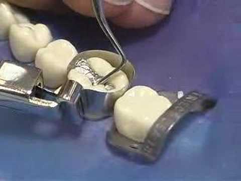 amalgum condensor - YouTube