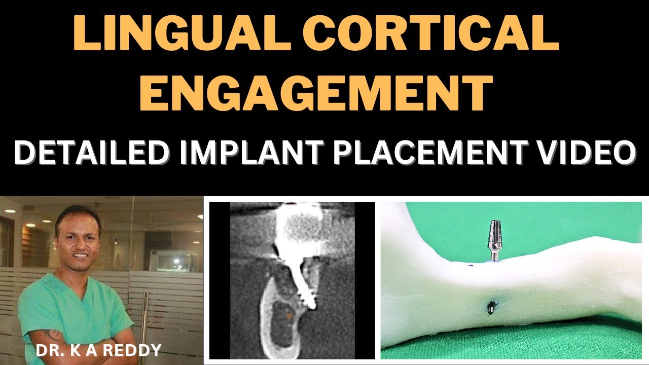 LINGUAL CORTICAL ENGAGEMENT PLACEMENT VIDEO |BASAL IMPLANTS |IMMEDIATE ...