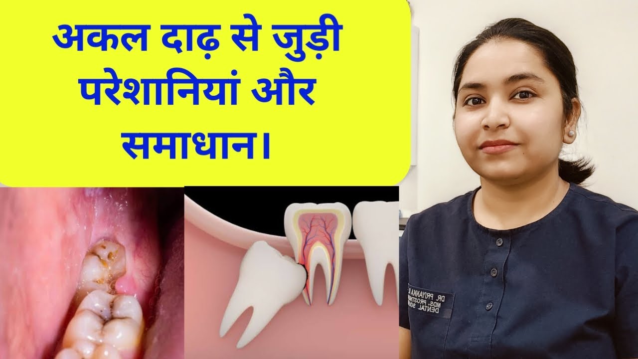 अकल दाढ़ से जुड़ी परेशानियों और समाधान। Wisdom tooth - YouTube