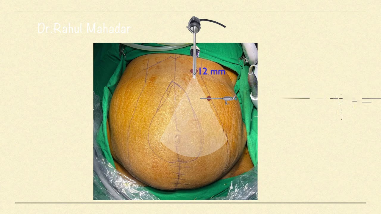 eTEP RS repair for incisional hernia with divarication of recti ...