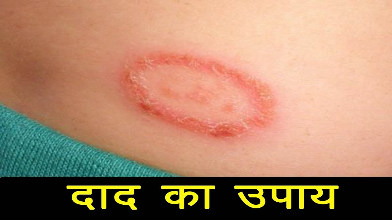 Daad Ka Ilaj || Daad Ka Gharelu Ilaj || Ringworm treatment - YouTube