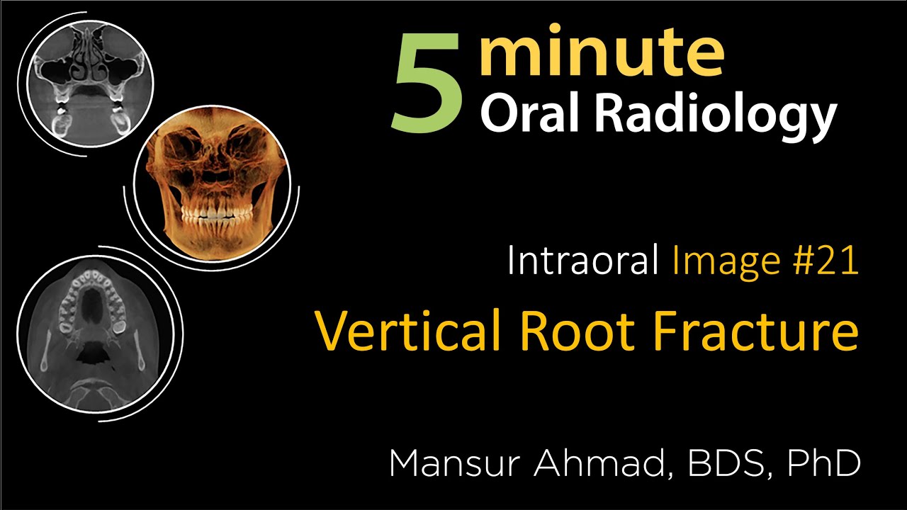 Vertical root fracture: Intraoral Radiographic Interpretation - YouTube