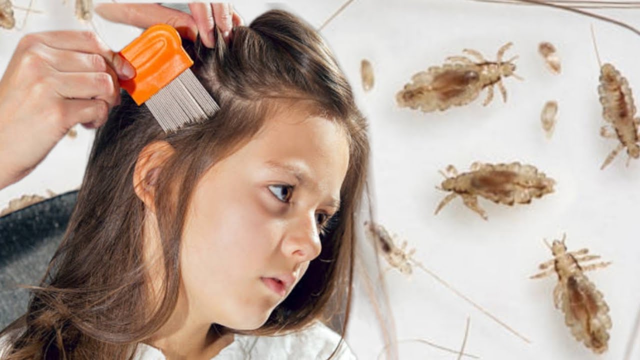 Mga Dahilan Kung Bakit Nagkakaroon Ng Kuto Sa Buhok At Ulo - Kuto At ...