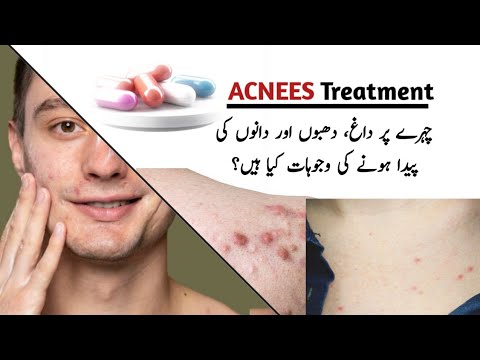 Acne growth causes|| Acne treatmentAcne scare treatment|| how to remove ...