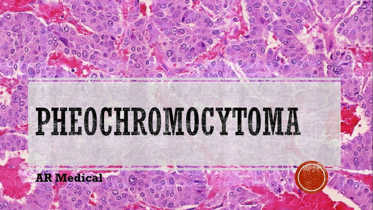 Pheochromocytoma (Pathophysiology, Symptoms, Treatment) - YouTube