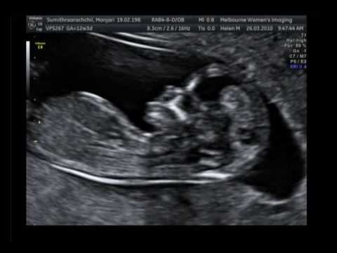 Our first baby's 12 week scan - YouTube
