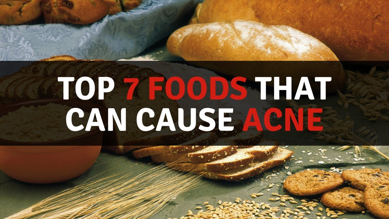 Top 7 Foods That Can Cause Acne | Foods To Avoid - YouTube