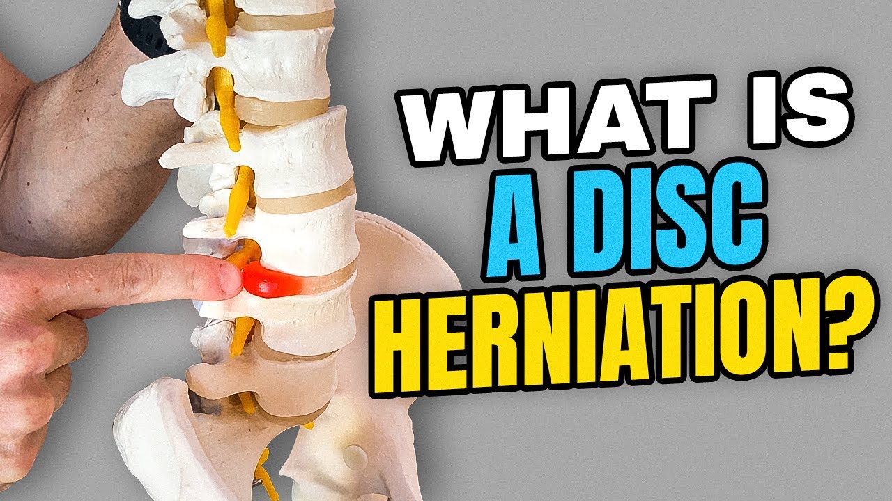 What Is a Disc Bulge? - YouTube