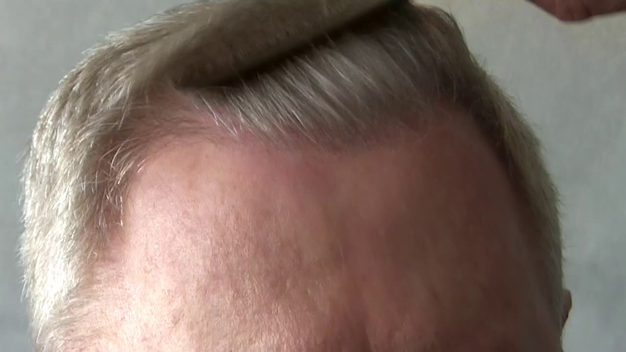Restoration of Mid-Scalp and Frontal Region- FUT 4946 - YouTube