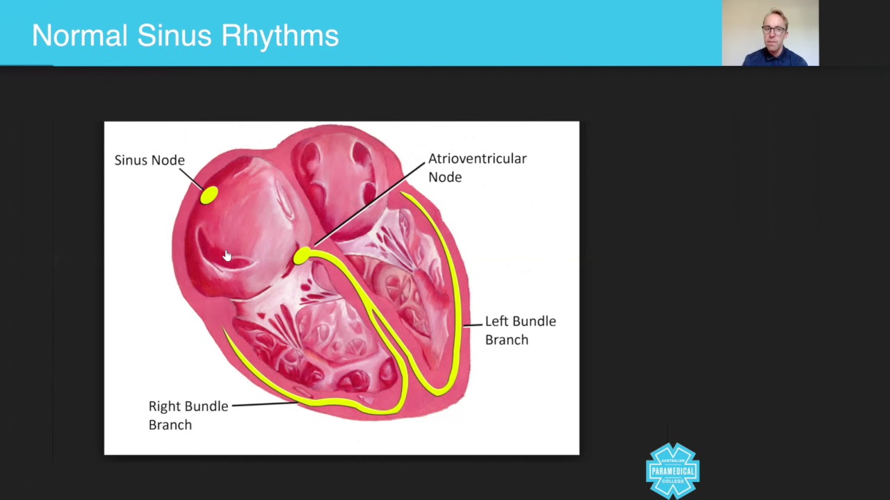 Normal Sinus Rhythms - Australian Paramedical College - YouTube